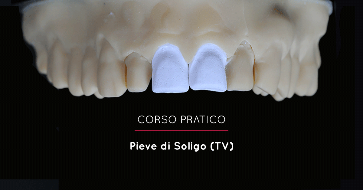 Faccette Estetiche in Ceramica: Protocolli tecnici analogici e digitali ...