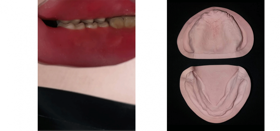 Il montaggio dei denti in protesi totale: classi edentule e scelta dei ...